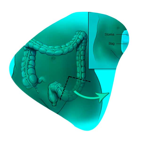 Colostomía Cirugía Aparato Digestivo
